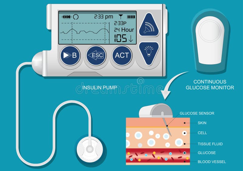 Insulin Pump is an Electronic Device Stock Vector - Illustration of ...
