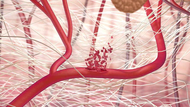 Internal Bleeding is One of the Most Serious Consequences of Trauma ...