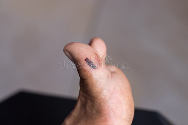 Internal bleeding toe stock photo. Image of blood, bleeding - 143805084