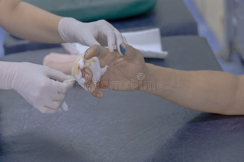 Internal Fixation of Finger Fractures Stock Image - Image of fracture ...