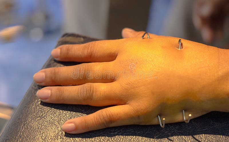 Internal Fixation of Hand Fractures Stock Photo - Image of medicine ...