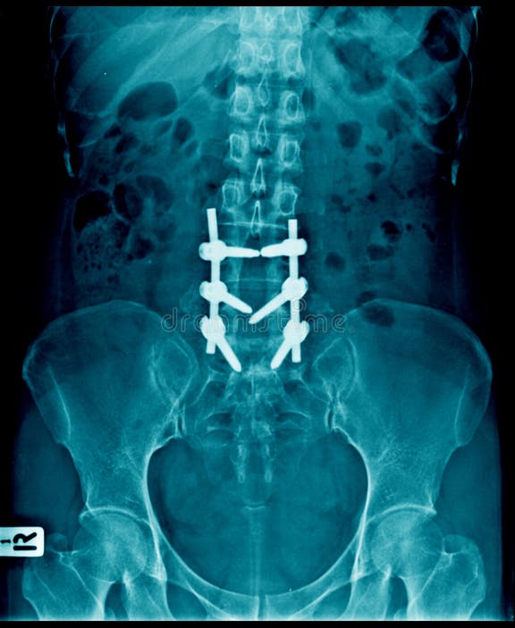 Internal fixation stock image. Image of curve, aged, diagnosis - 95002205
