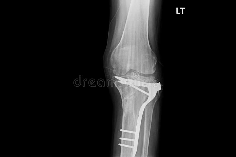 Internal of Left Leg Fixed with Plate and Screws Stock Image - Image of ...