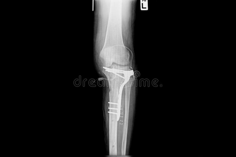 Internal of Left Leg Fixed with Plate and Screws Stock Image - Image of ...