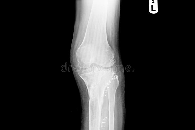 Internal of Left Leg Fixed with Plate and Screws Stock Image - Image of ...