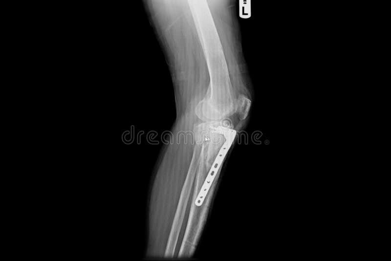 Tibia And Fibula Compound Fracture