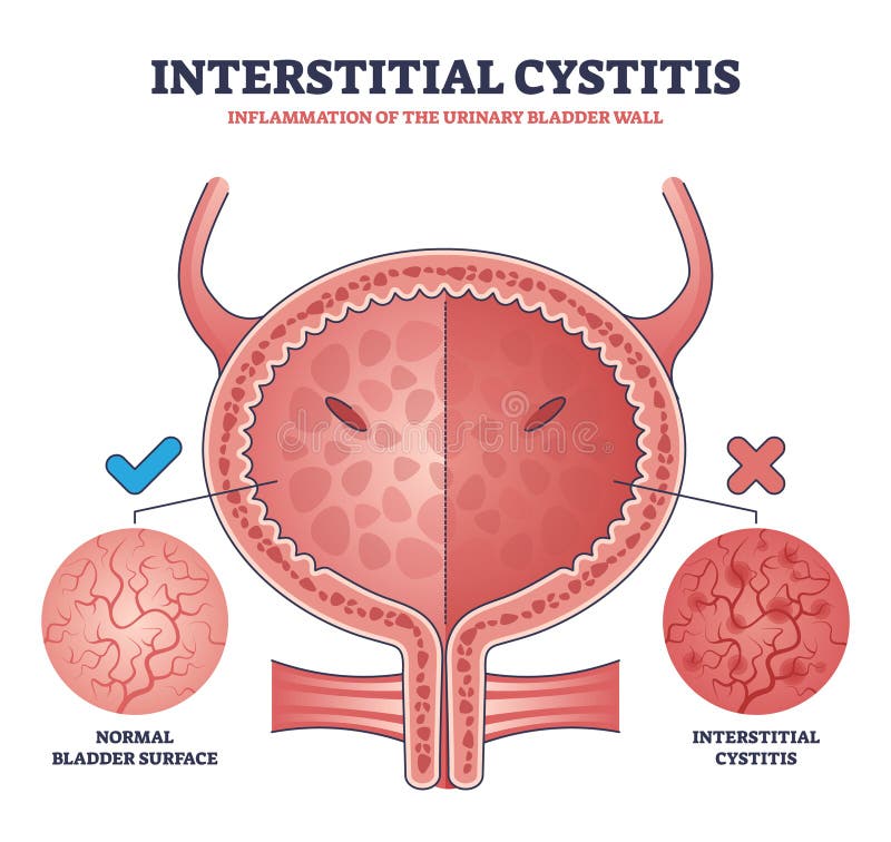 Cystitis. Inflammation of the Bladder. the Structure of the Kidneys and ...
