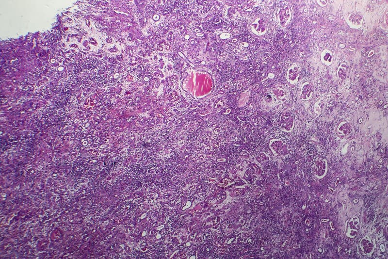 Interstitial Nephritis, Light Micrograph Stock Image - Image of tissue ...