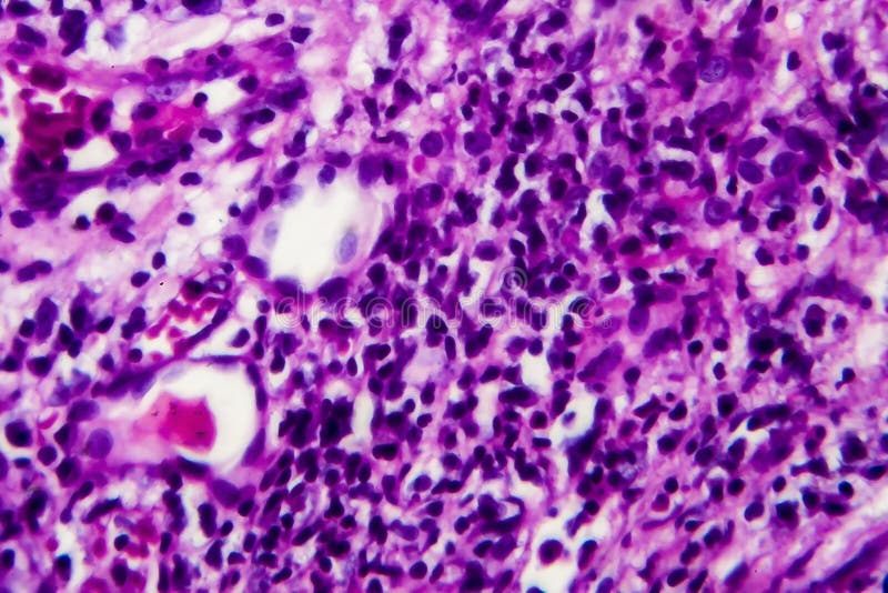 Interstitial Nephritis, Light Micrograph Stock Photo - Image of ...