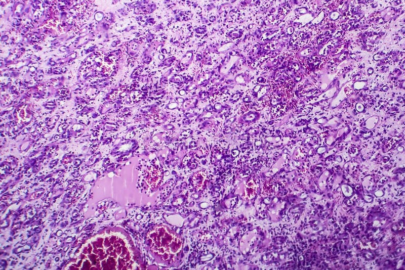 Interstitial Nephritis, Light Micrograph Stock Photo - Image of medical ...