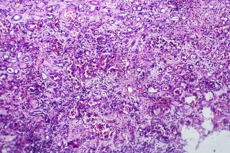 Interstitial Nephritis, Light Micrograph Stock Image - Image of ...