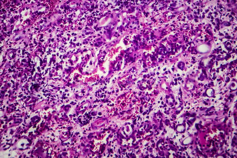 Interstitial Nephritis, Light Micrograph Stock Photo - Image of medical ...