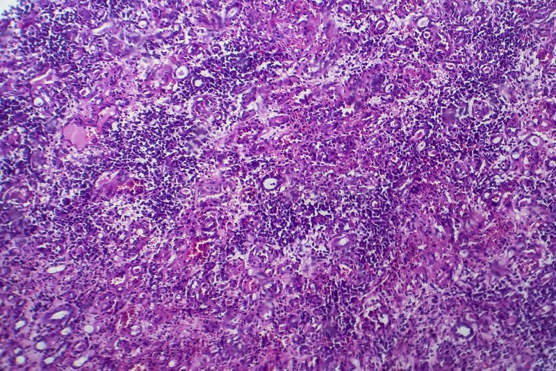 Interstitial Nephritis, Light Micrograph Stock Image - Image of ...