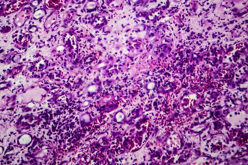 Interstitial Nephritis, Light Micrograph Stock Photo - Image of ...