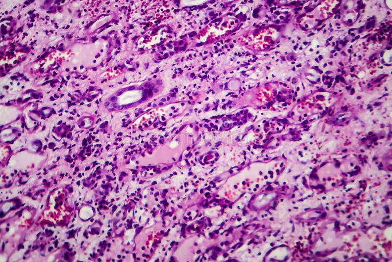 Interstitial Nephritis, Light Micrograph Stock Image - Image of ...