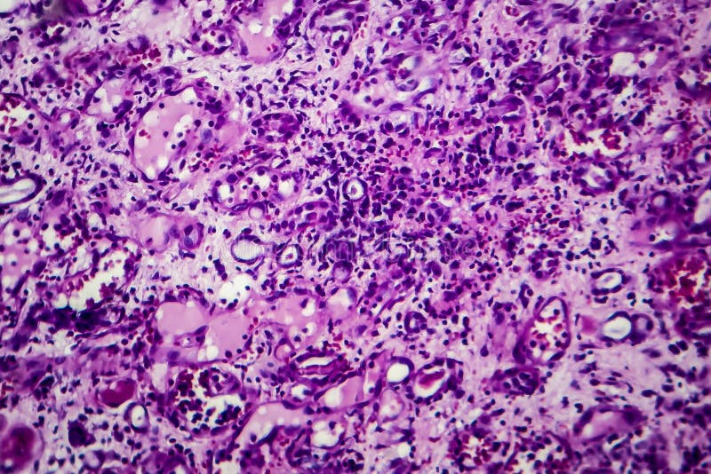 Interstitial Nephritis, Light Micrograph Stock Photo - Image of ...