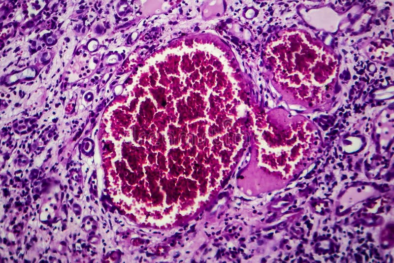 Interstitial Nephritis, Light Micrograph Stock Image - Image of urinary ...