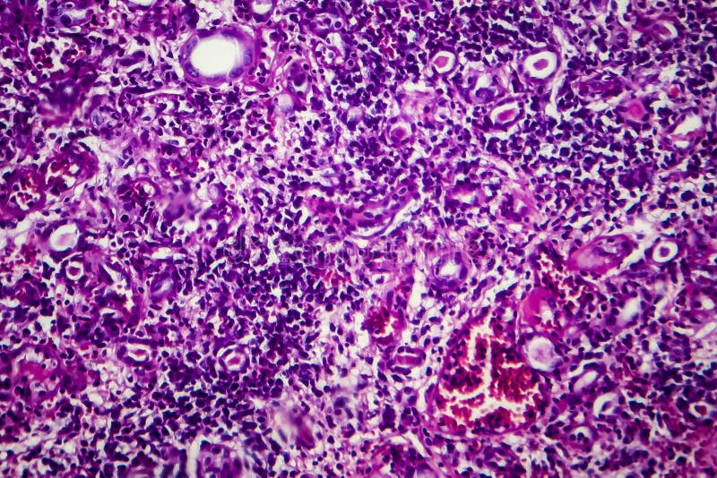 Interstitial Nephritis, Light Micrograph Stock Image - Image of micro ...