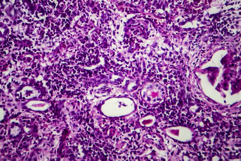 Interstitial Nephritis, Light Micrograph Stock Image - Image of tissue ...