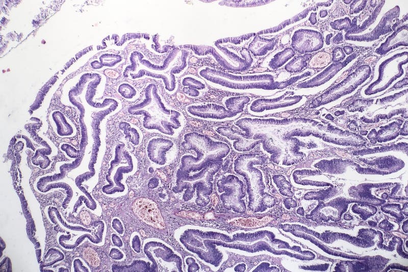 Intestinal Adenomas, Light Micrograph Stock Photo - Image of intestinal ...