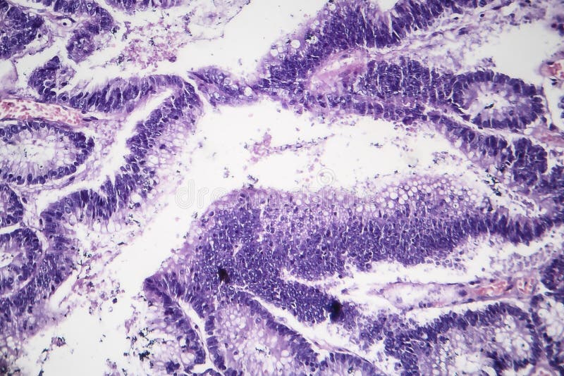 Intestinal Adenomas, Light Micrograph Stock Photo - Image of ...