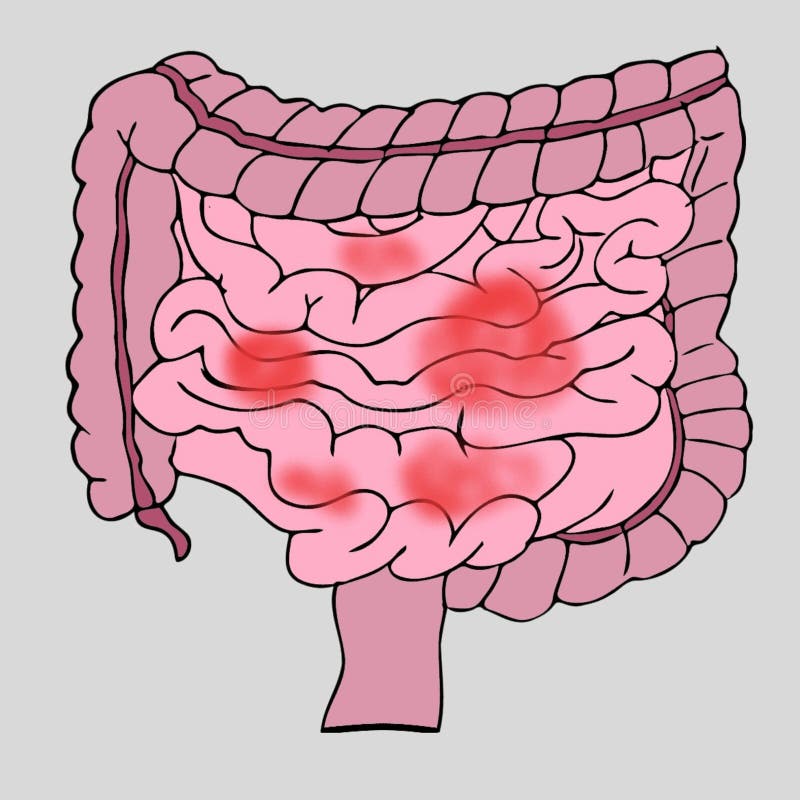 Intestinal Inflammation Illustration Biology Stock Illustration ...