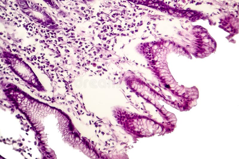 Intestinal Metaplasia, Light Micrograph Stock Photo - Image of ...