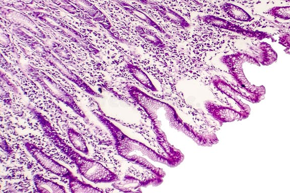 Intestinal Metaplasia, Light Micrograph Stock Photo - Image of gastric ...