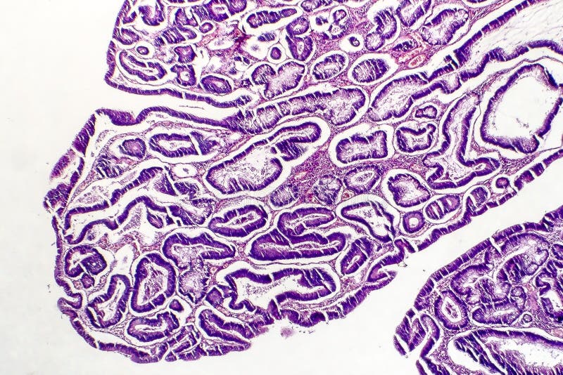 Intestinal Polypoid Adenoma Stock Photo - Image of cell, histology ...