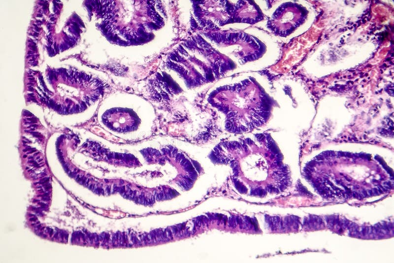 Intestinal Polypoid Adenoma Stock Image - Image of pathohistology ...