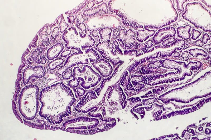 Intestinal Polypoid Adenoma Stock Image - Image of microscope, micro ...