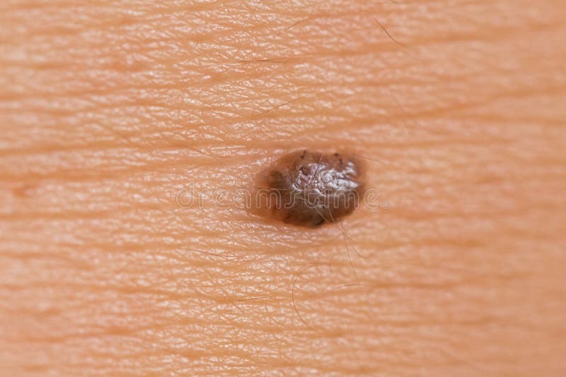Intradermal nevus stock image. Image of medical, tumor - 25491715