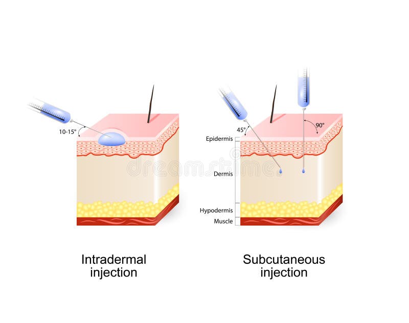 Subcutaneous Injection