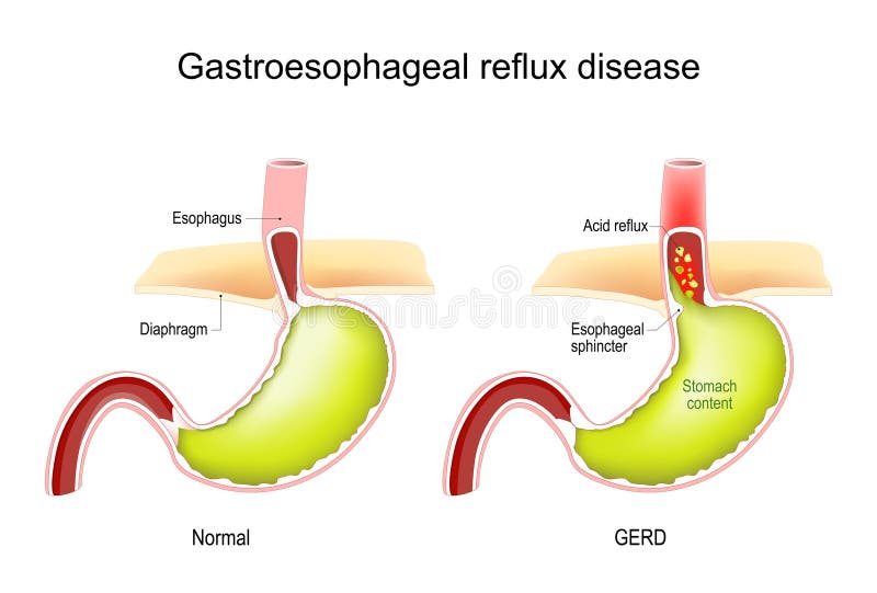 Gastroesophageal Reflux Disease Stock Vector - Illustration of body ...