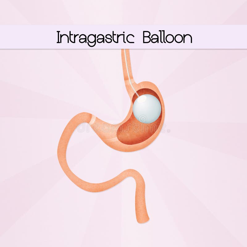 Intragastric balloon stock illustration. Illustration of intestines ...
