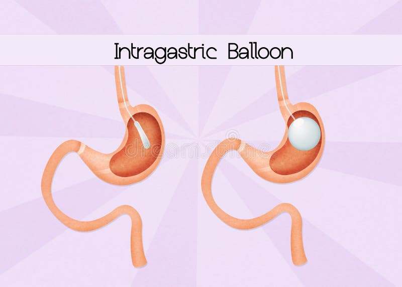 Intragastric balloon stock illustration. Illustration of balloon - 76859913