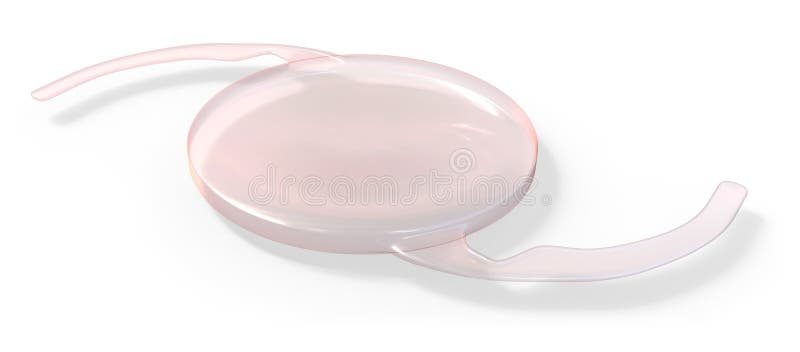 Intraocular lens implant stock illustration. Illustration of health ...