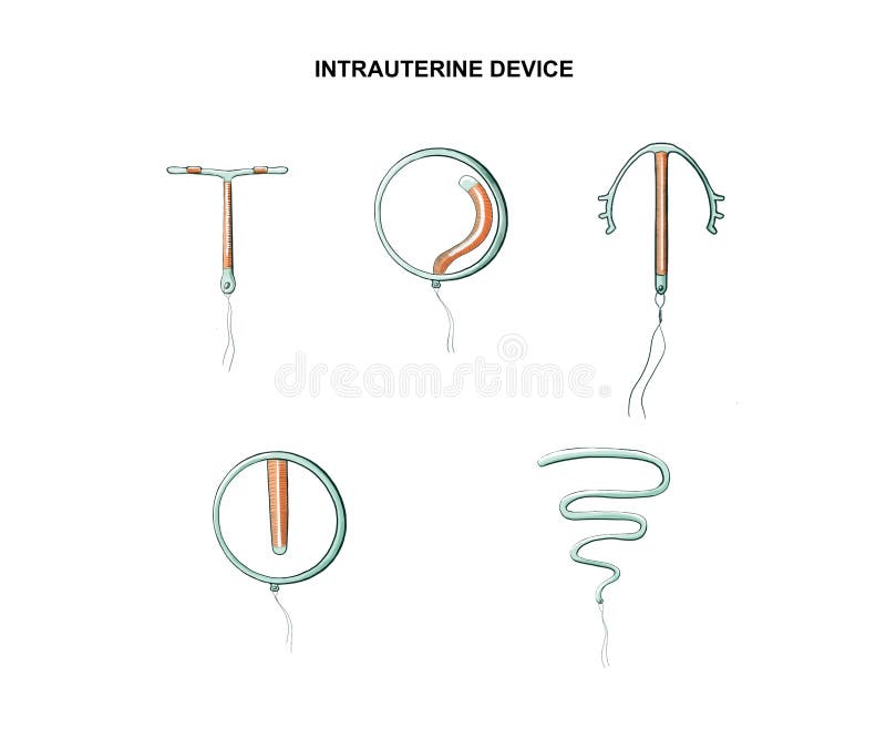Intrauterine spiral stock vector. Illustration of method - 19848903