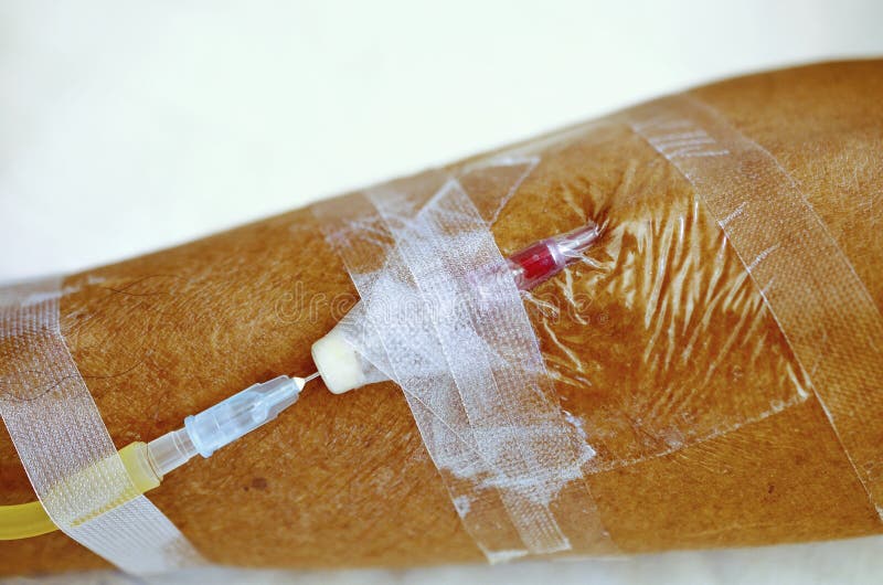 Intraveneuze injectie stock afbeelding. Image of verpleegster - 36015167