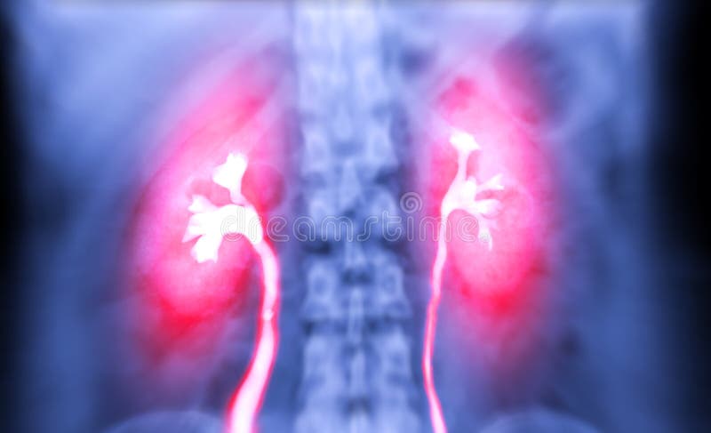 Ivp Intravenous Pyelogram Ten Minutes After Administration Of