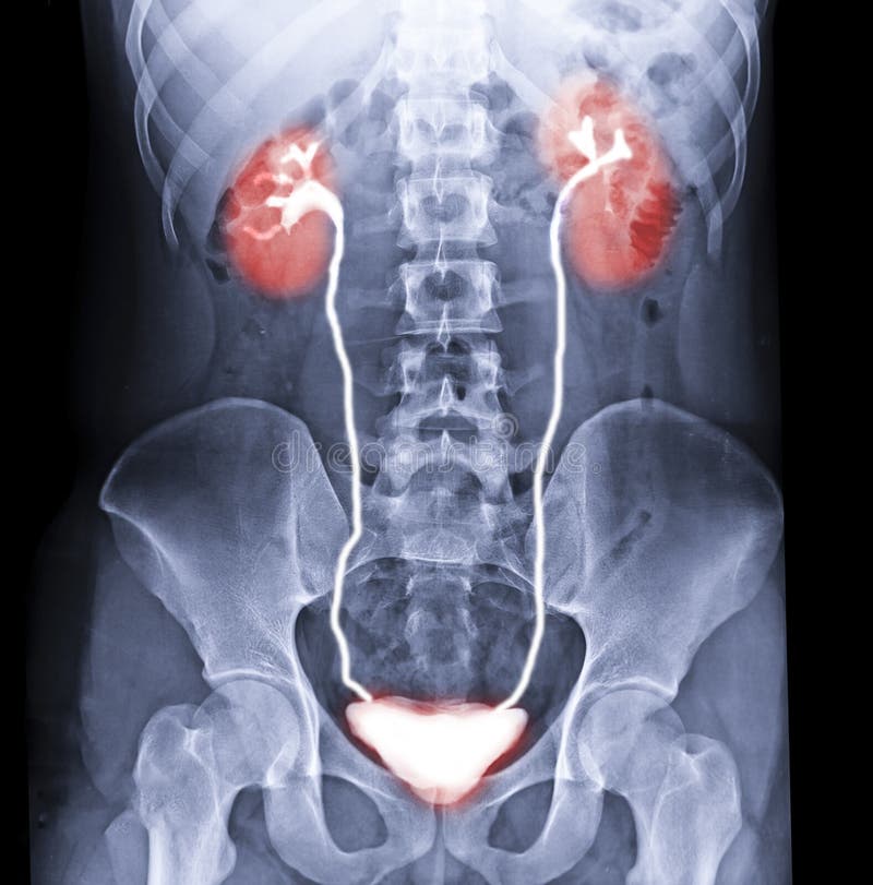 Intravenous Pyelogram Or I V P Is An X Ray Exam Of Urinary Tract After