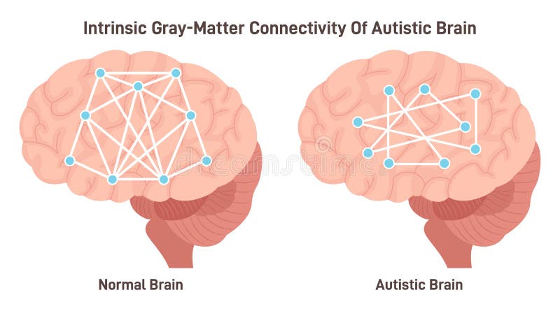Intrinsic Gray-matter Connectivity of Autistic Brain ...