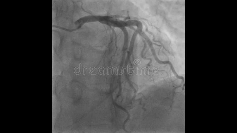 Coronary Angiography. X-ray Image. Vedio Angiogram Stock Footage ...