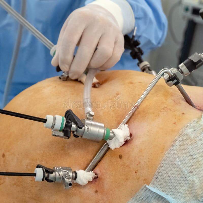 Laparoscopy. Square Frame Operating Room Surgical Hospital. the ...