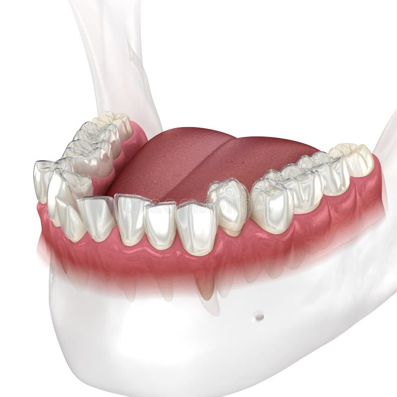 Invisalign Braces or Invisible Retainer Make Bite Correction. Medically ...