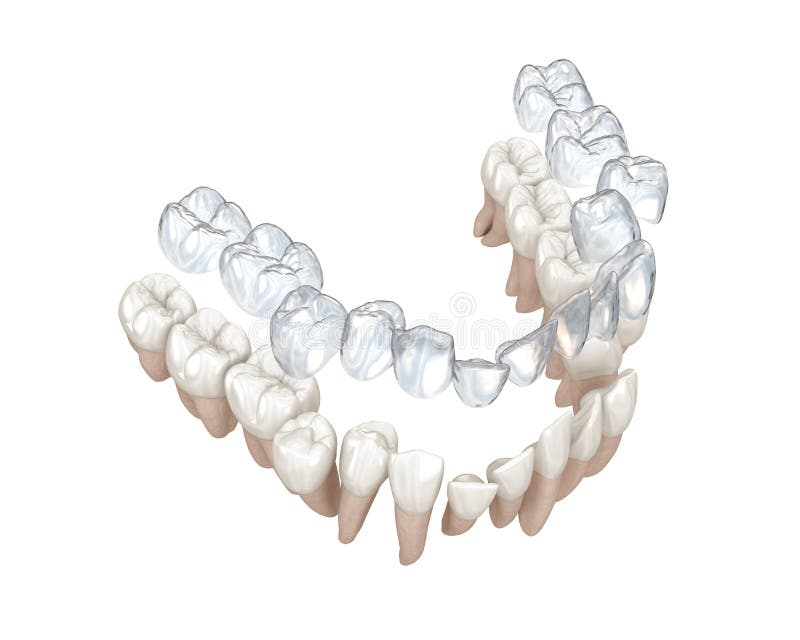 Invisalign Braces or Invisible Retainer Make Bite Correction. Medically ...