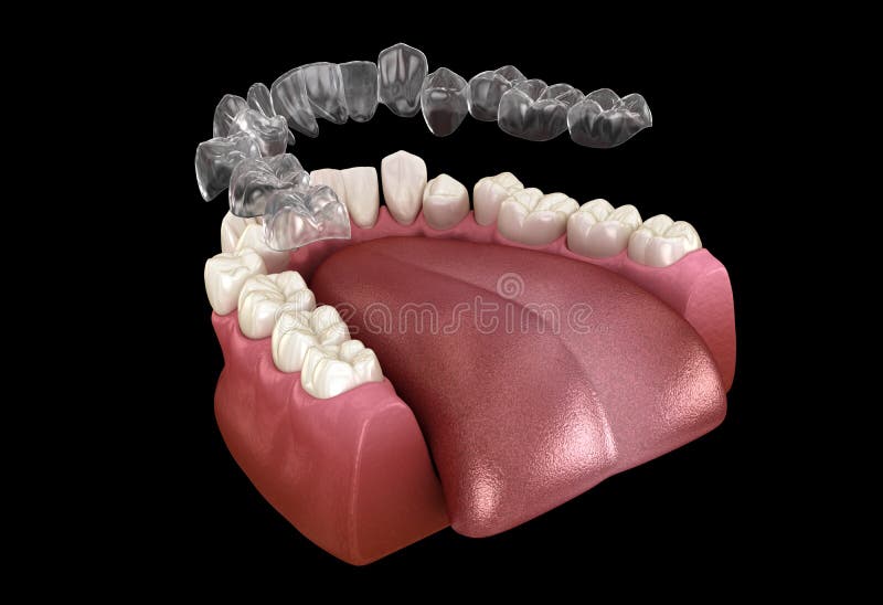 Invisalign Braces or Invisible Retainer Make Bite Correction. Medically ...