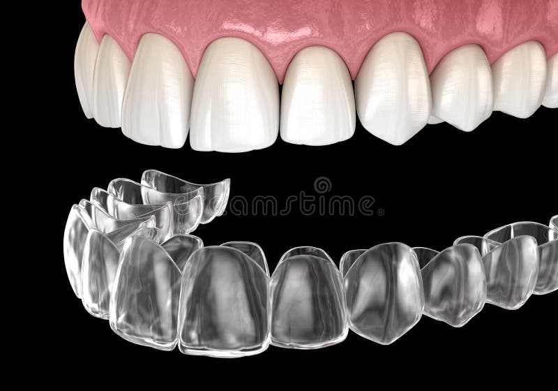 Invisalign Braces or Invisible Retainer. Medically Accurate Dental 3D ...