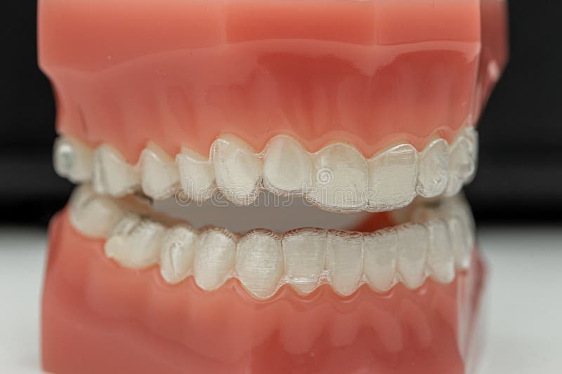 Invisible and Removable Aligners for Teeth Alignment. Stock Image ...