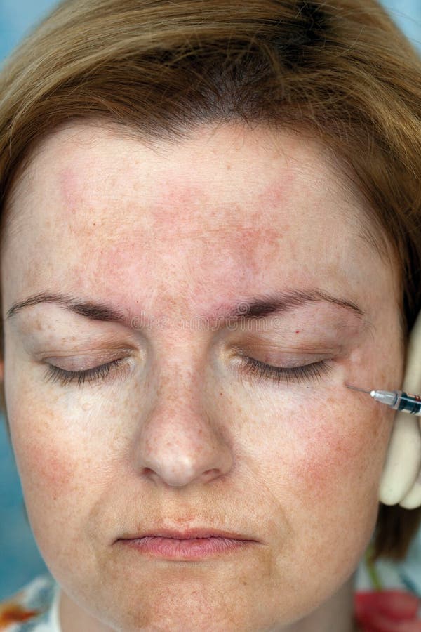 Inyección De Botox En El Arco Superciliar Foto de archivo - Imagen de ...